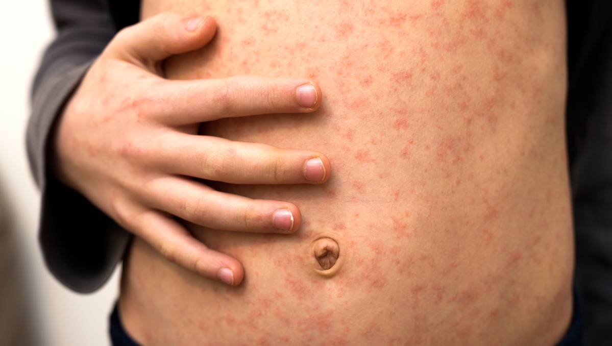 Dėl kritusių skiepijimo rodiklio Anglijoje galvą vėl kelia tymai ...